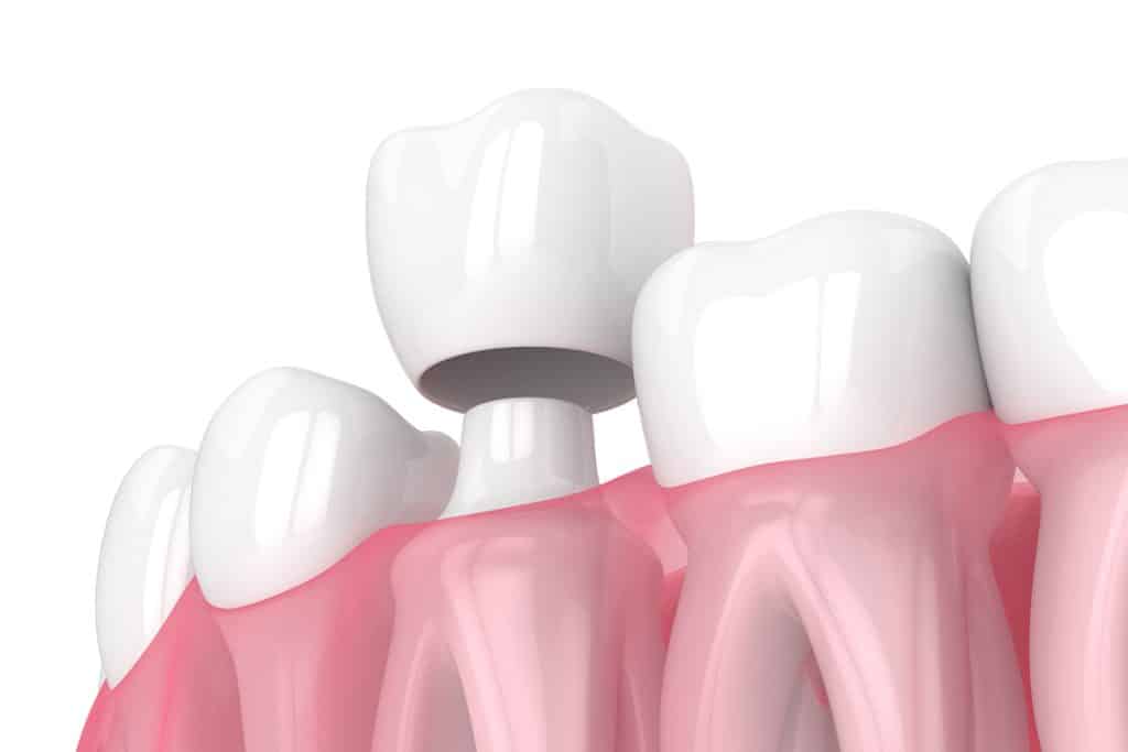 What to Do If Your Dental Crown Cracks or Falls Off - Suwanee Family ...